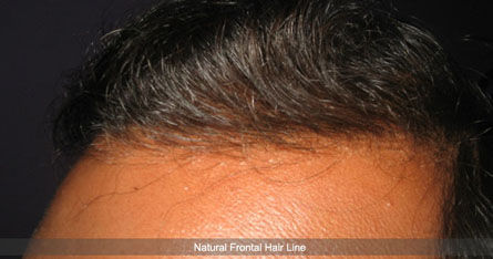 Natural Hairline | Best Hair Transplant Center Delhi, Jaipur