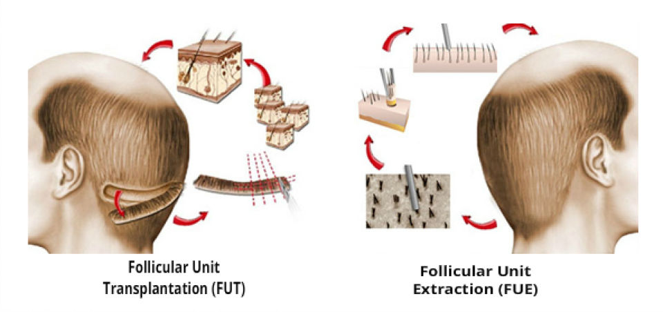 What is Better: FUT or FUE? Know the Difference | Medispa India