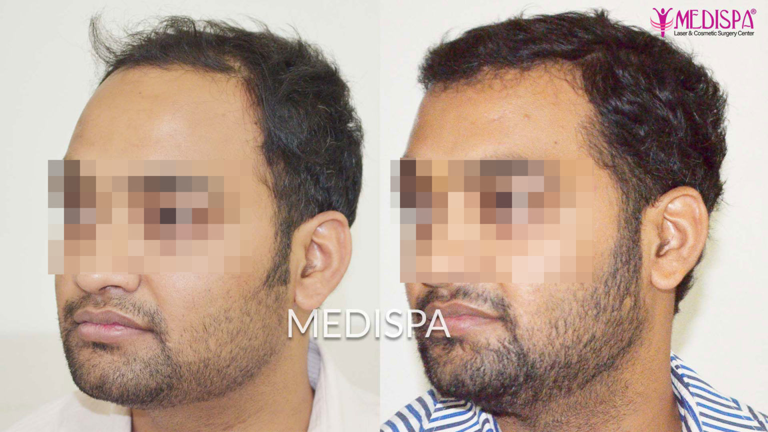 Importance Of Trichophytic Closure In FUT Hair Transplant