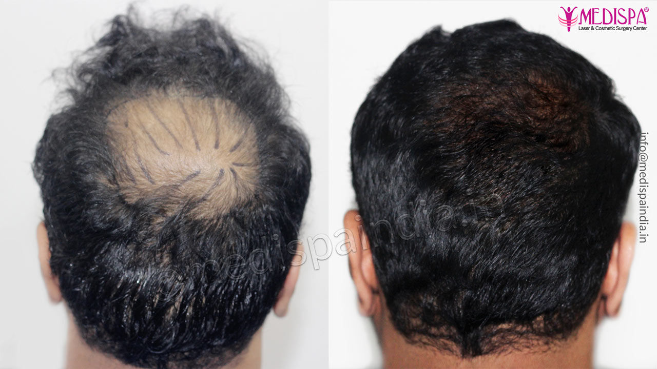 Vertex Hair Transplant Results in Jaipur - Medispa India