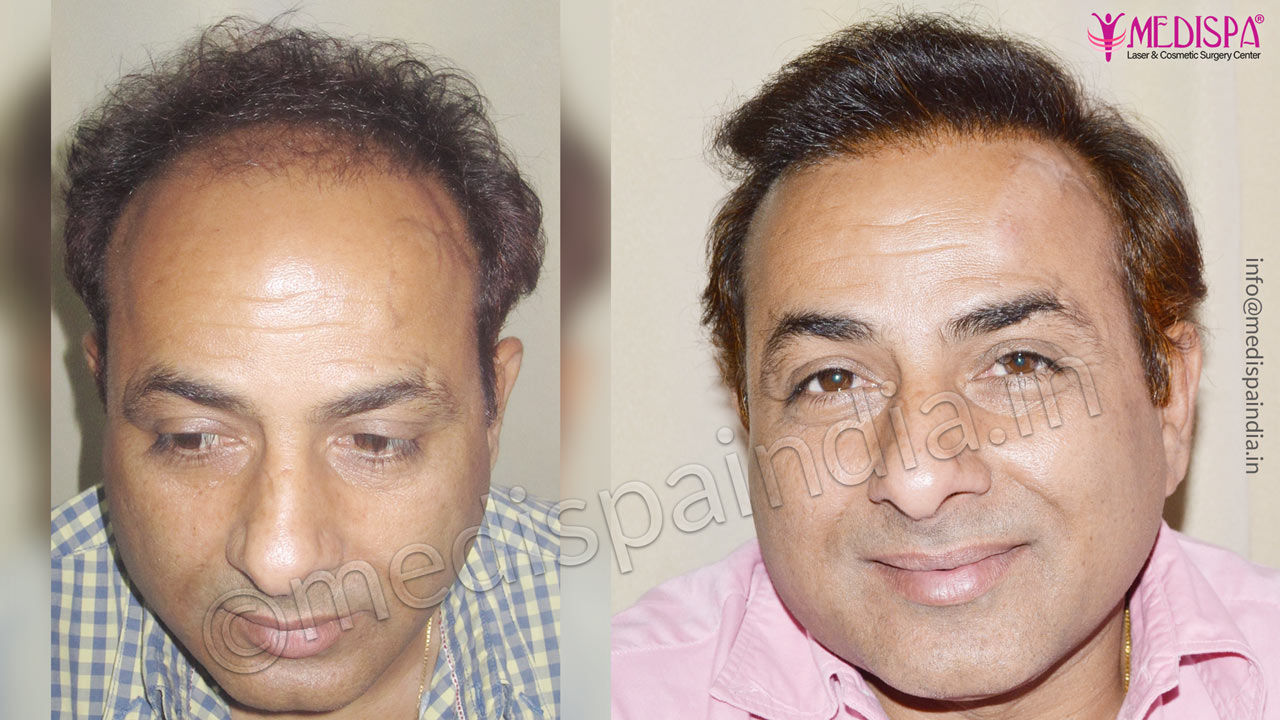 Wrong Bad Hair Transplant Correction Photo Gallery | Medispa India