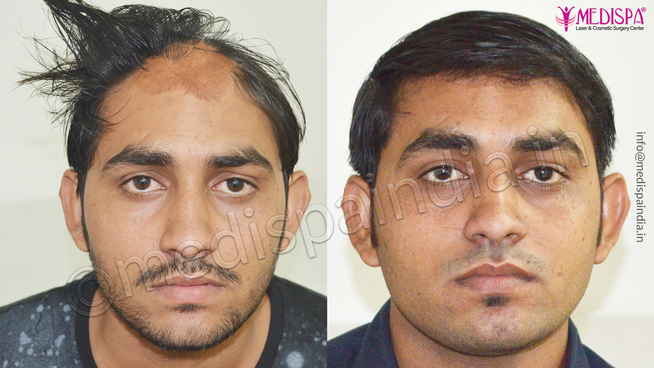 Burn Hair Transplant Before After Results | Medispa India