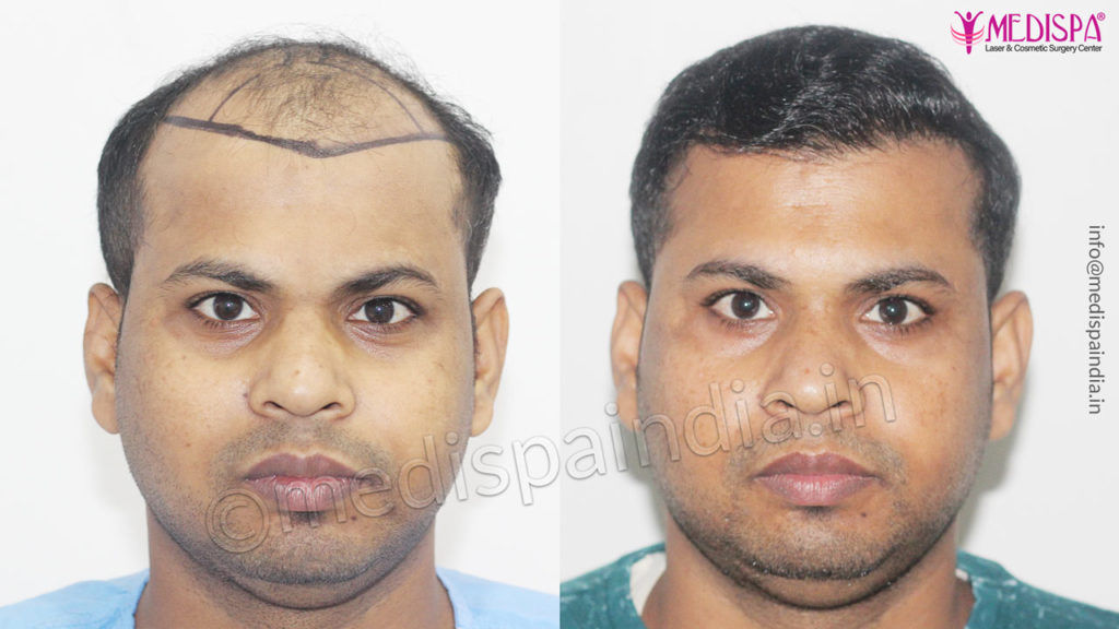 Combination Method FUT + FUE Hair Transplant Results