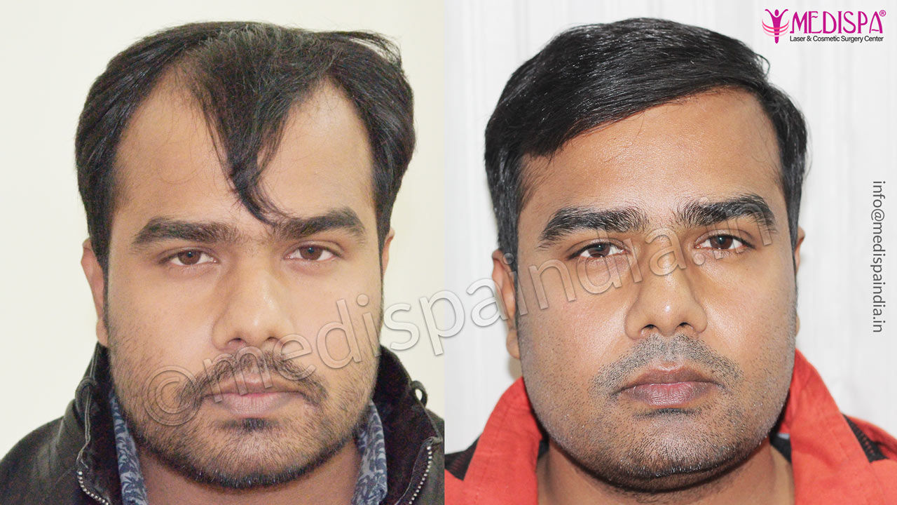 Hair Transplant Results After 6 Month | Medispa Clinic India