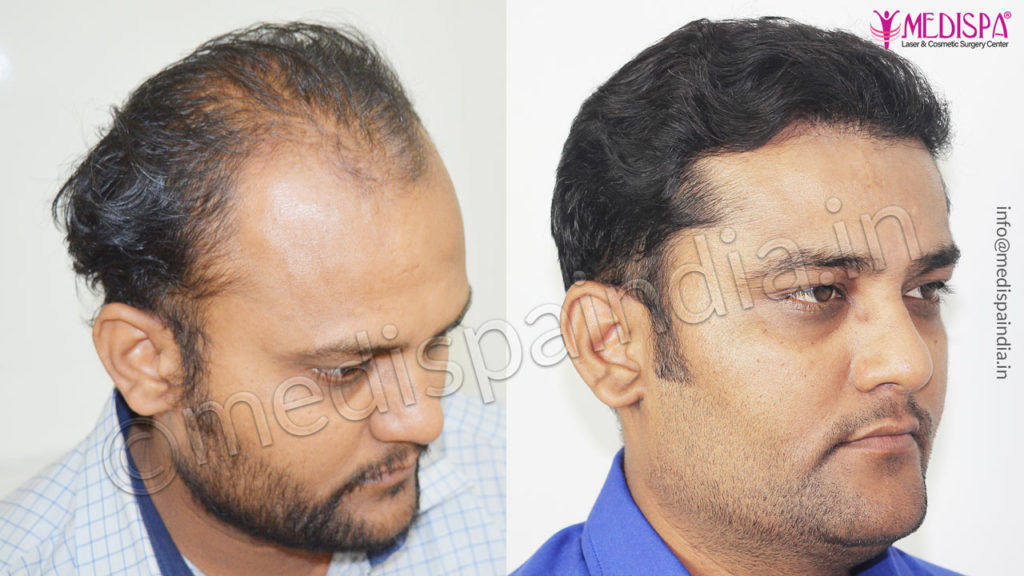 Best Hair Transplant Results In Mumbai At Medispa India