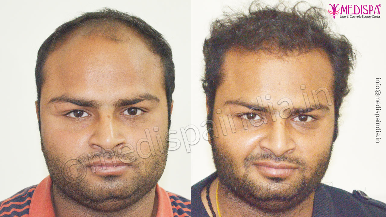 Hair Transplant Results After 6 Month | Medispa Clinic India