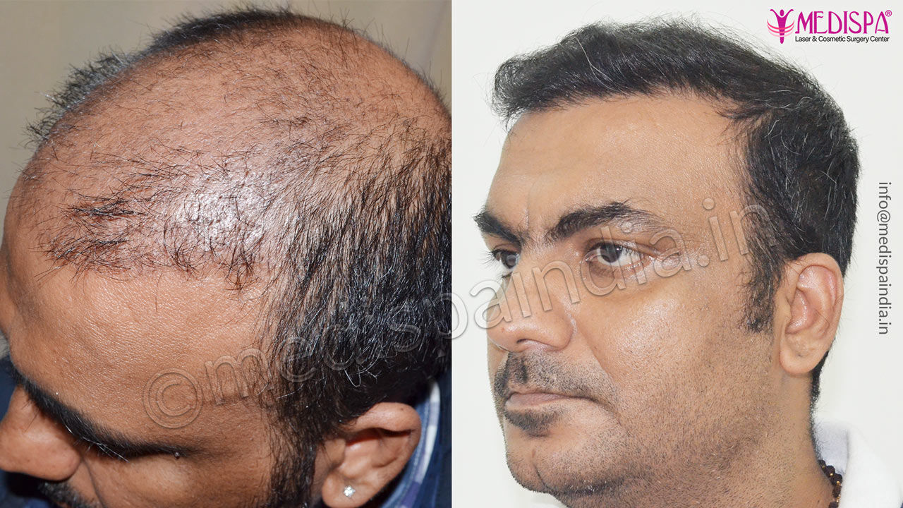 Wrong Bad Hair Transplant Correction Photo Gallery | Medispa India