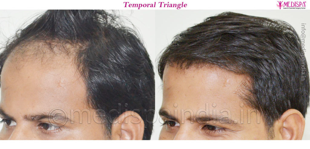 Best Hair Transplant Results in Mumbai at Medispa India