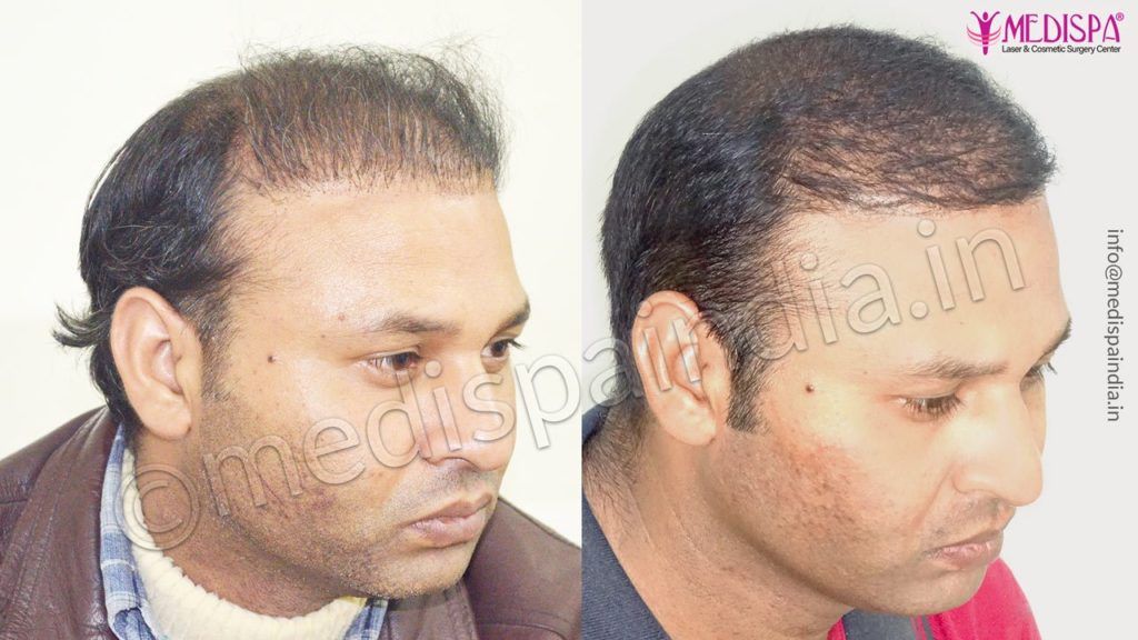 Failed Hair Transplant Repair | Medispa India