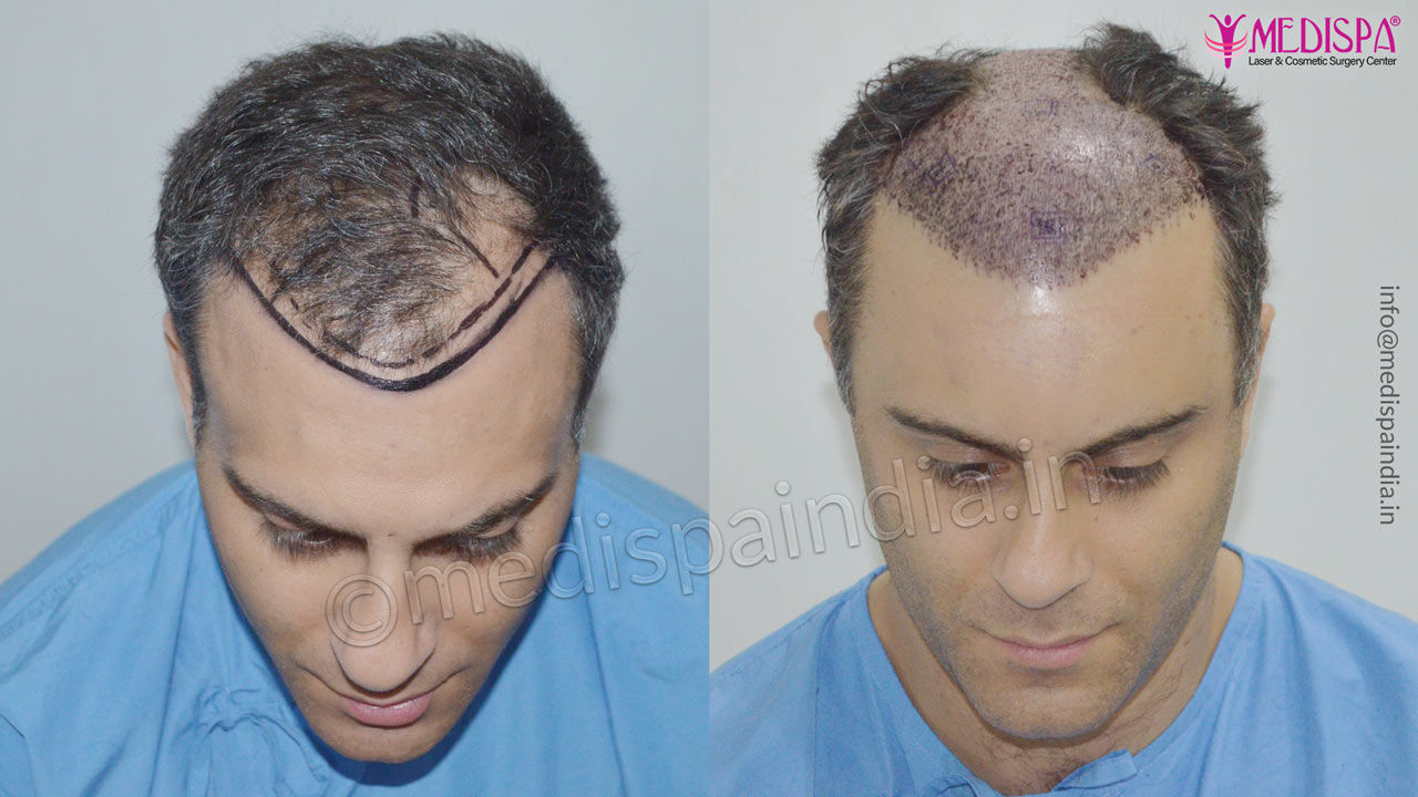 Hair Transplant Before and After - UK