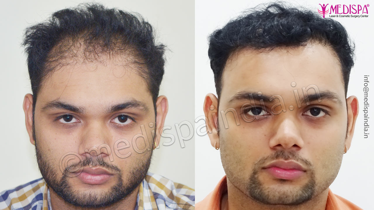 Wrong Bad Hair Transplant Correction Photo Gallery | Medispa India