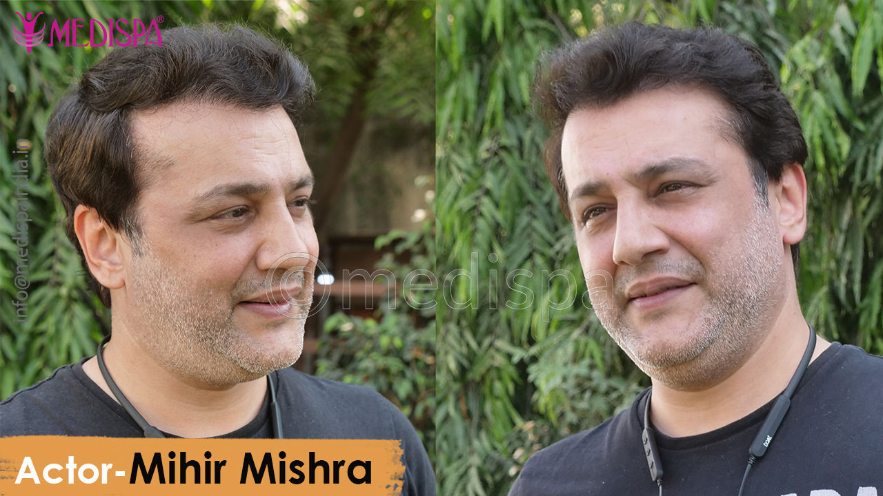 Bollywood Actor Mihir Mishra Hair Transplant Results