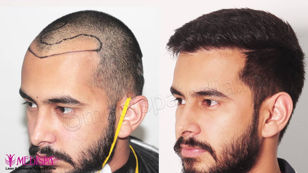 Best Hair Transplant Results Jaipur India
