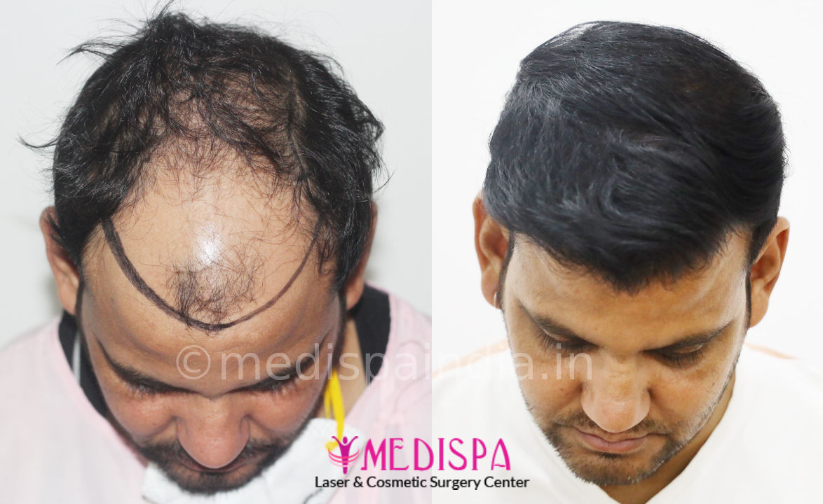 Best Hair Transplant Results in India - Gallery