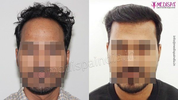 Why is the Giga/Mega Hair Transplant Session Required