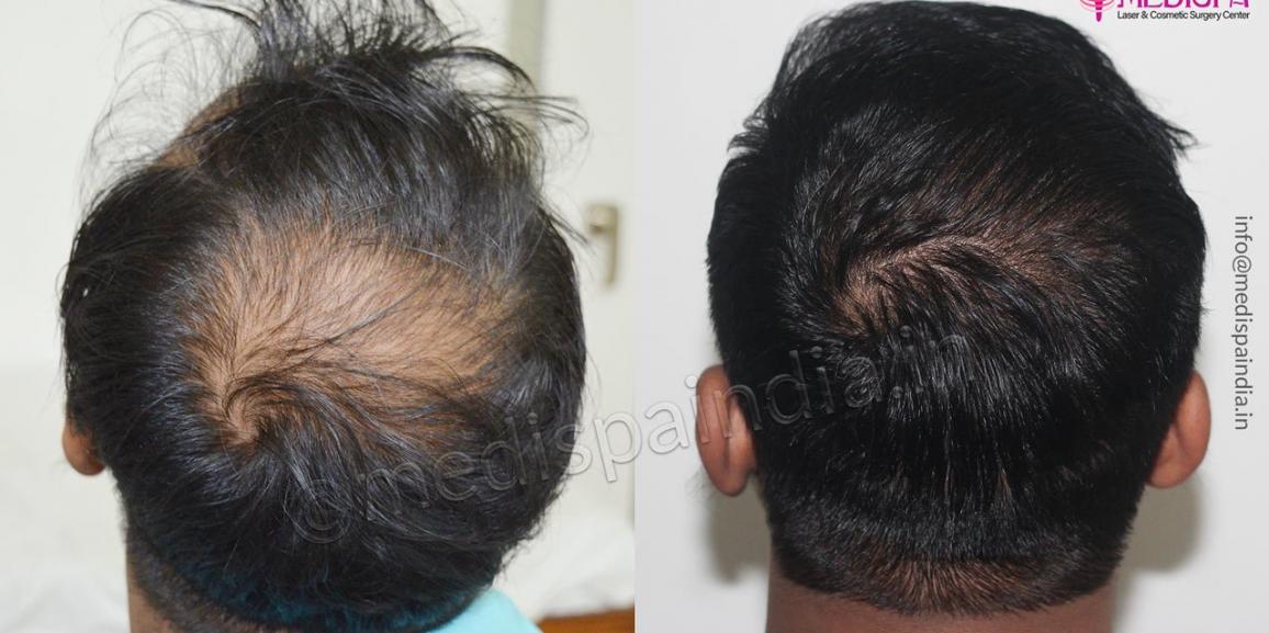 Why is the Giga/Mega Hair Transplant Session Required