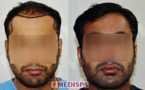 Why is the Giga/Mega Hair Transplant Session Required