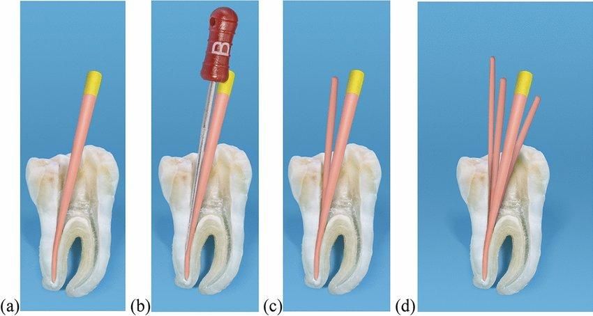 What is Gutta Percha and When to use it? | Medikabazaar