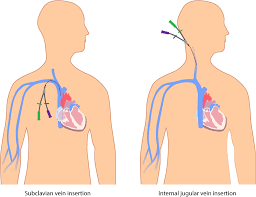IV Cannula - What is it & How to use it? | Medikabazaar